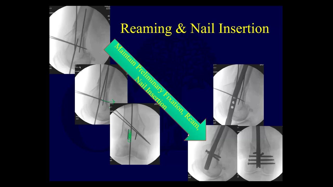 Distal femur fractures - Retrograde nailing and traditional plating ...
