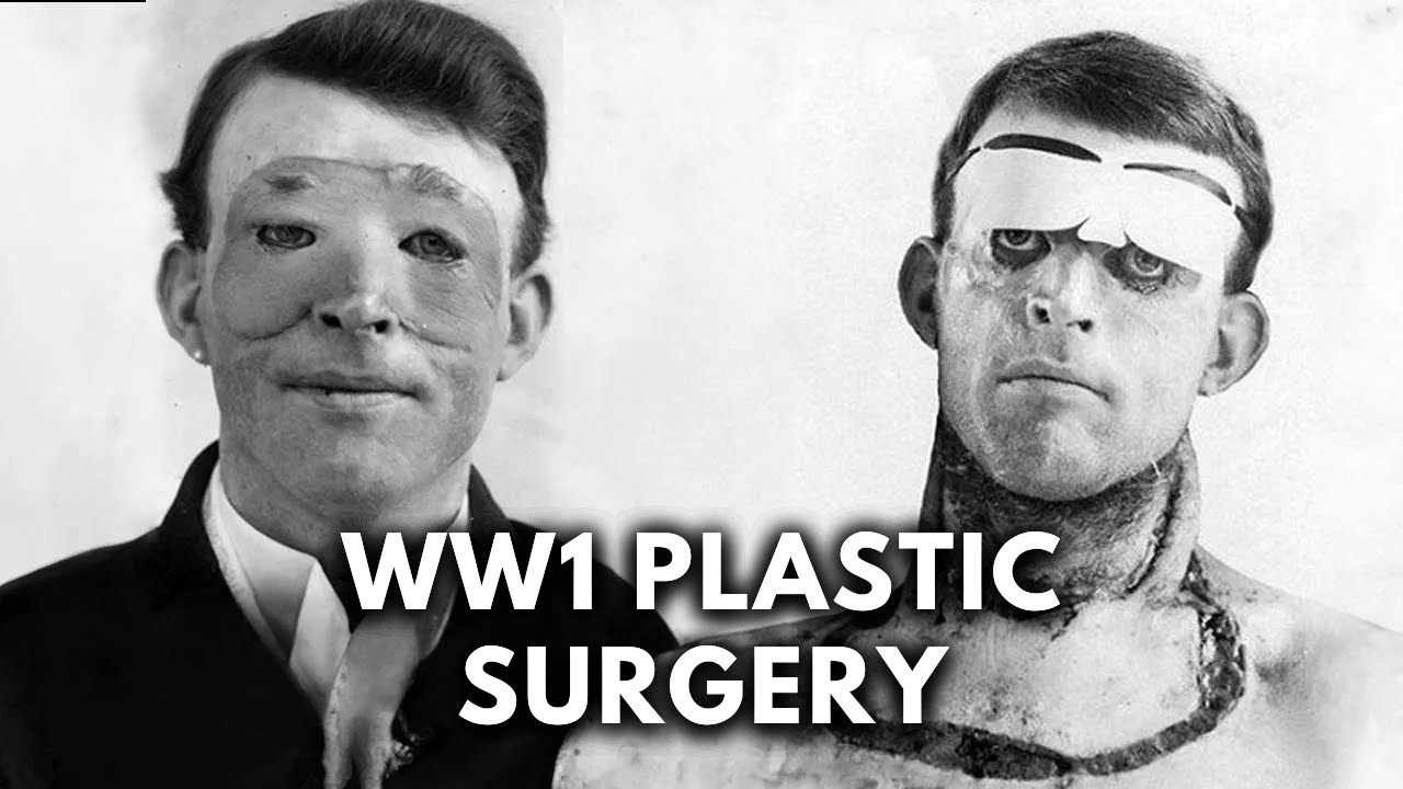The Dark History of WW1 Plastic Surgery - YouTube