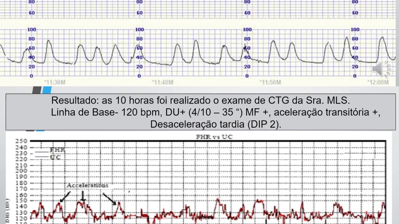 Alguns exames de Cardiotocografia fetal para estudos. # ...