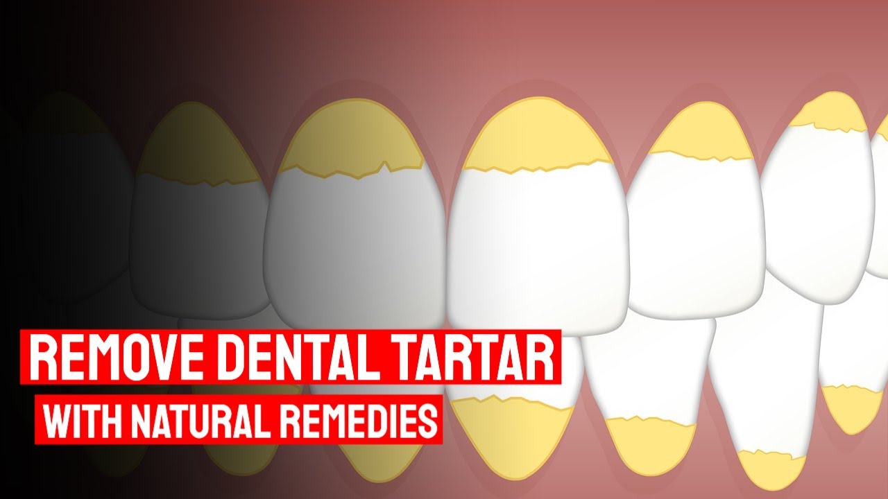 Remove Dental Tartar With Natural Remedies - YouTube