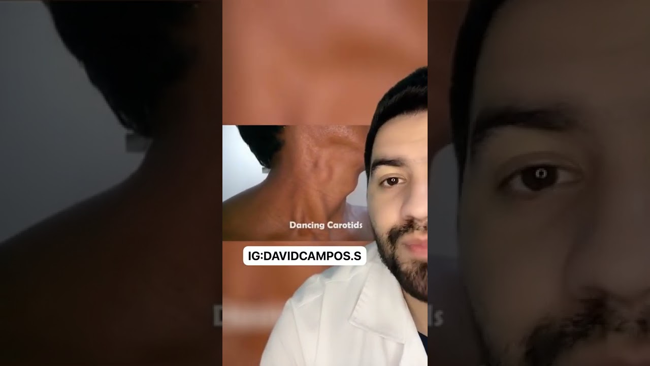 LA VENA QUE BAILA / CAROTIDA DANZANTE / SIGNO DE CORRIGAN - YouTube