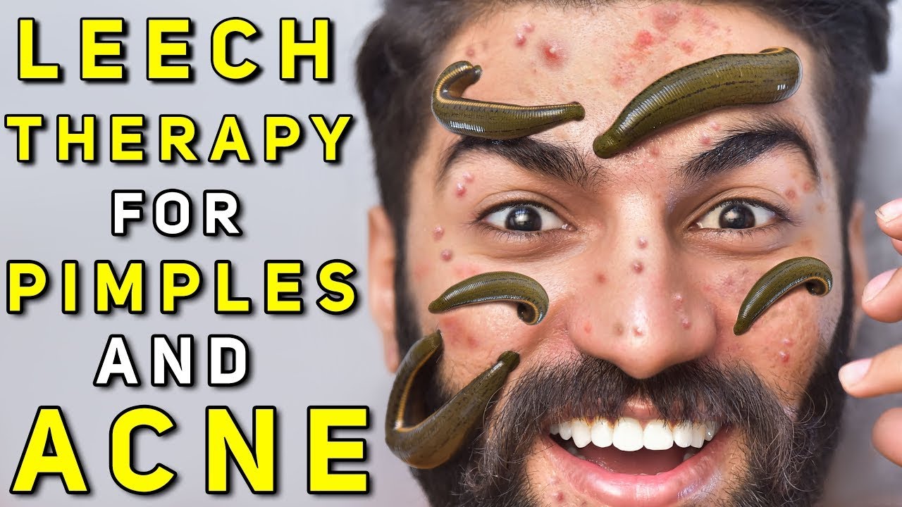 Leech Therapy for Skin Problems like Acne, Pimples !!! - YouTube