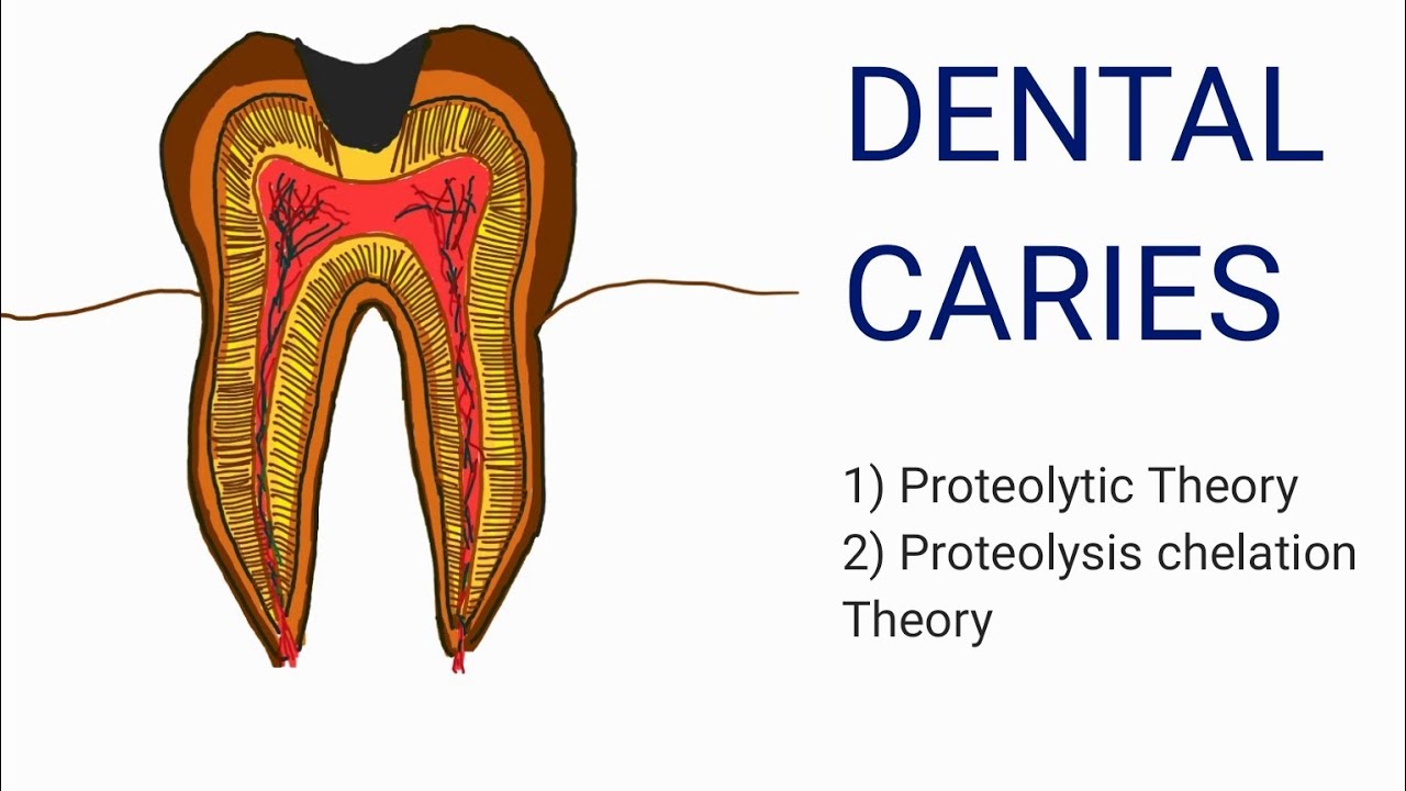 DENTAL CARIES PART 2( Proteolytic theory and proteolysis chelation ...