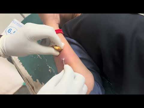 Abscess on forearm with pus popping and discharge - YouTube