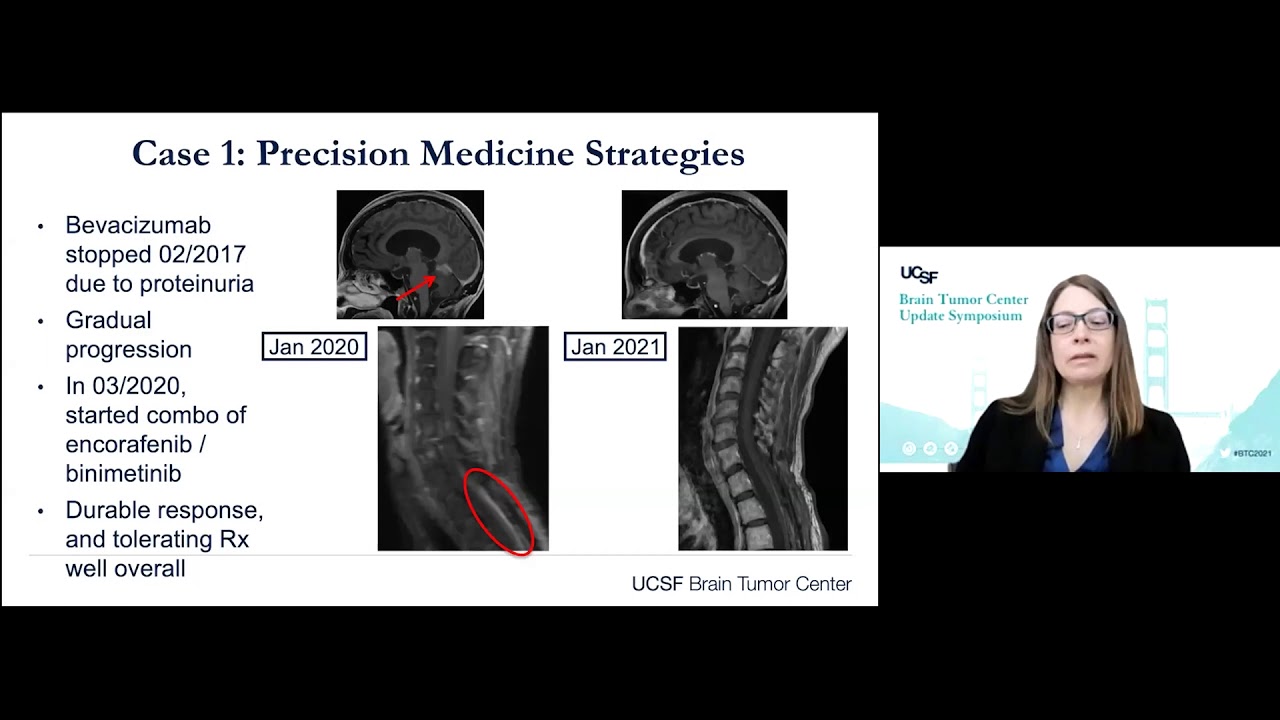 Precision Medicine for Gliomas - Jennifer Clarke, MD, MPH - YouTube