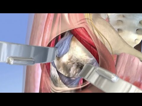 How To Run After Hip Replacement Surgery