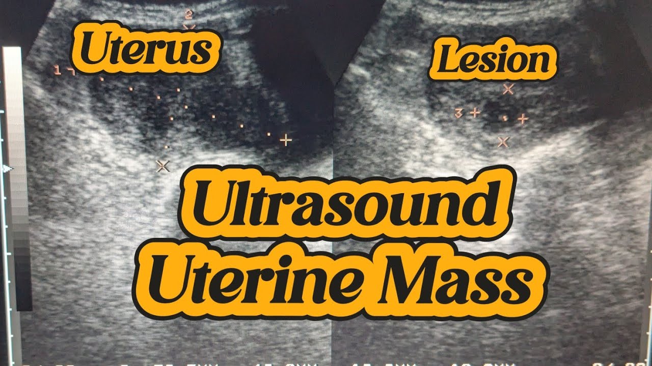 Uterine Mass | Uterine Fibroid | Uterine Tumor | Uterine Cancer ...