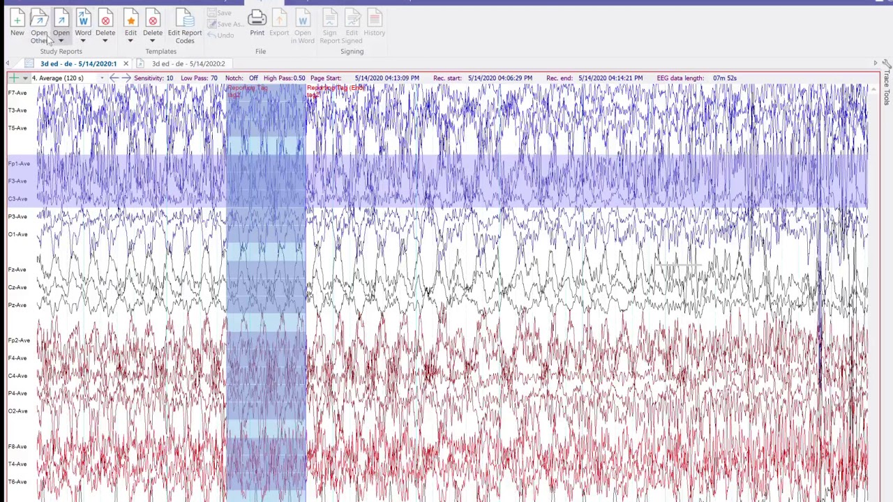 ProFusion EEG 6 3d ed de 5 14 2020 2020 11 04 14 52 46 - YouTube