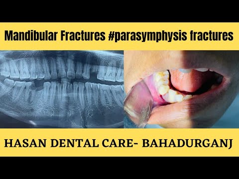 Lower mandibular Fractures, parasymphysis fracture, mandibular ...