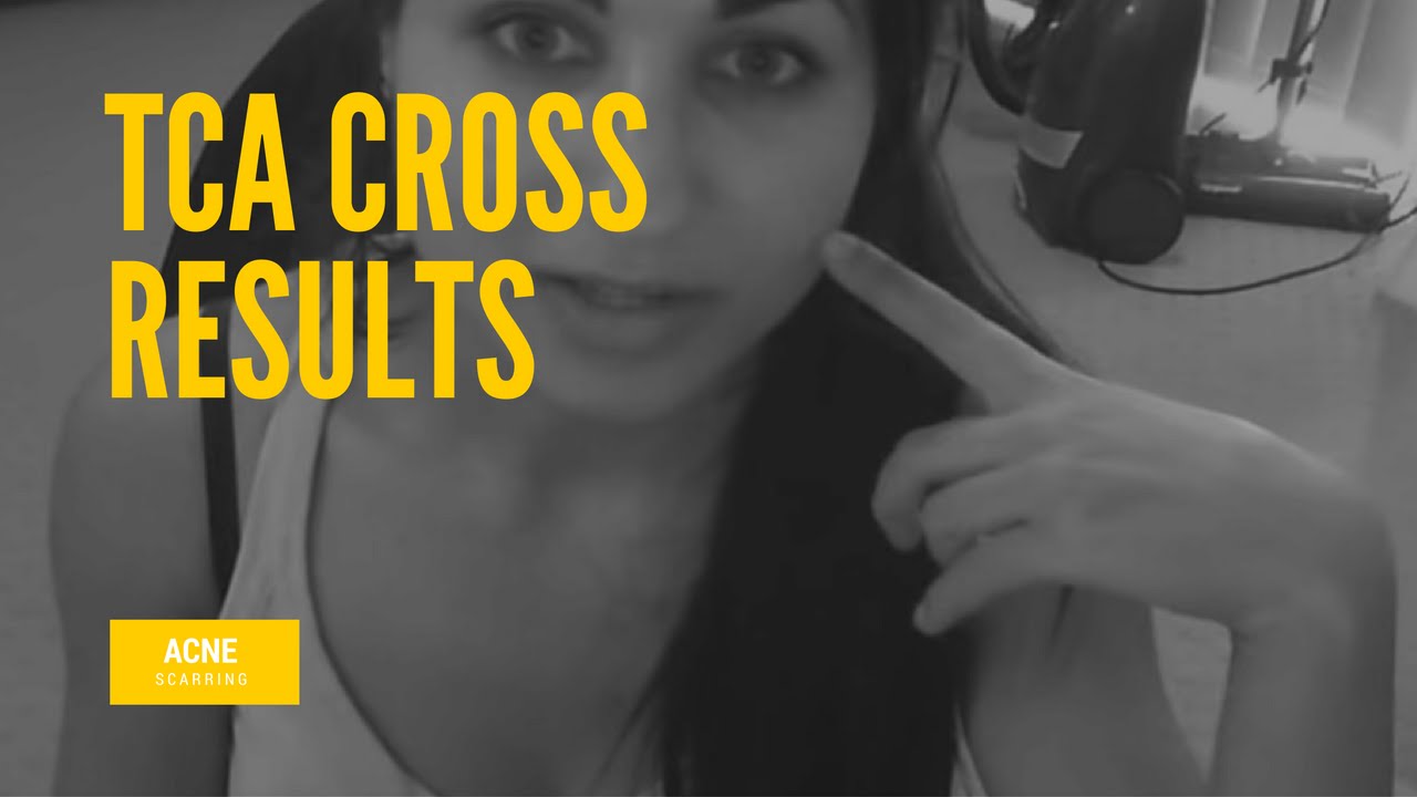 TCA Cross Chemical Peel for Acne Scarring (For Ice Pick Scars etc ...