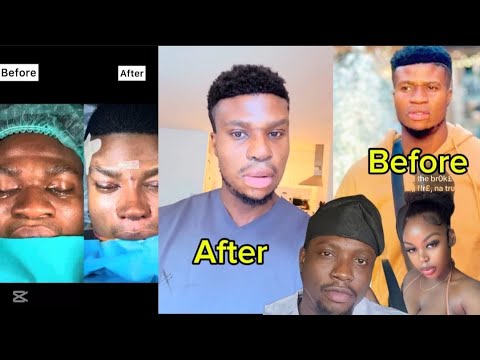 Zics Aloma Rhinoplasty Update: VDM vs Saida Boj + 10-Day Face Reveal! # ...