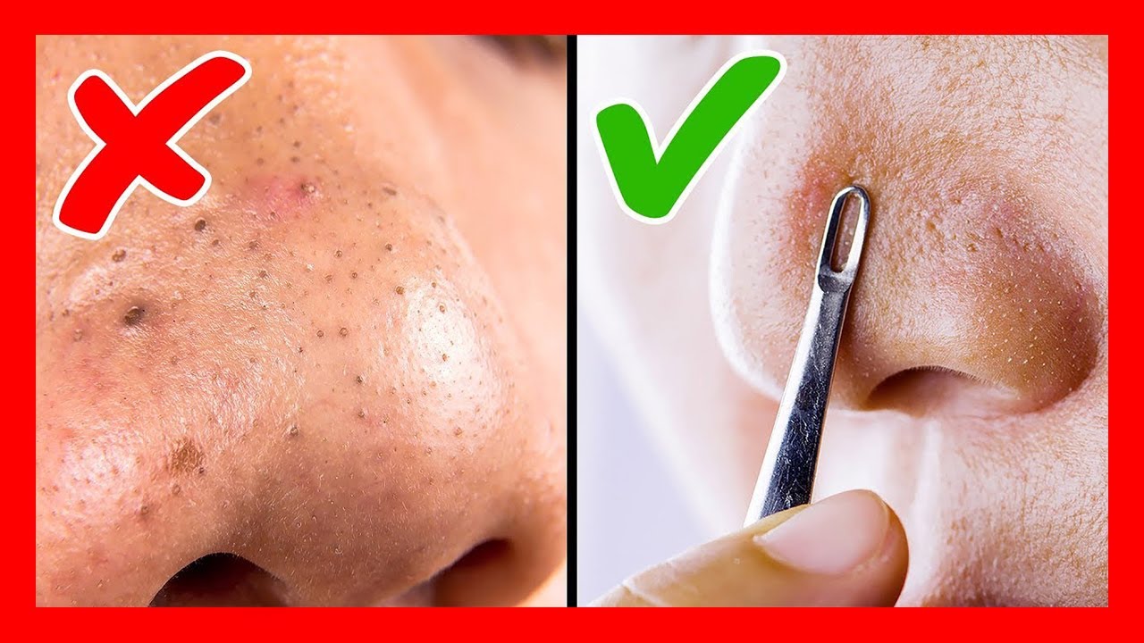 Extractor de COMEDONES CERRADOS para la CARA - YouTube