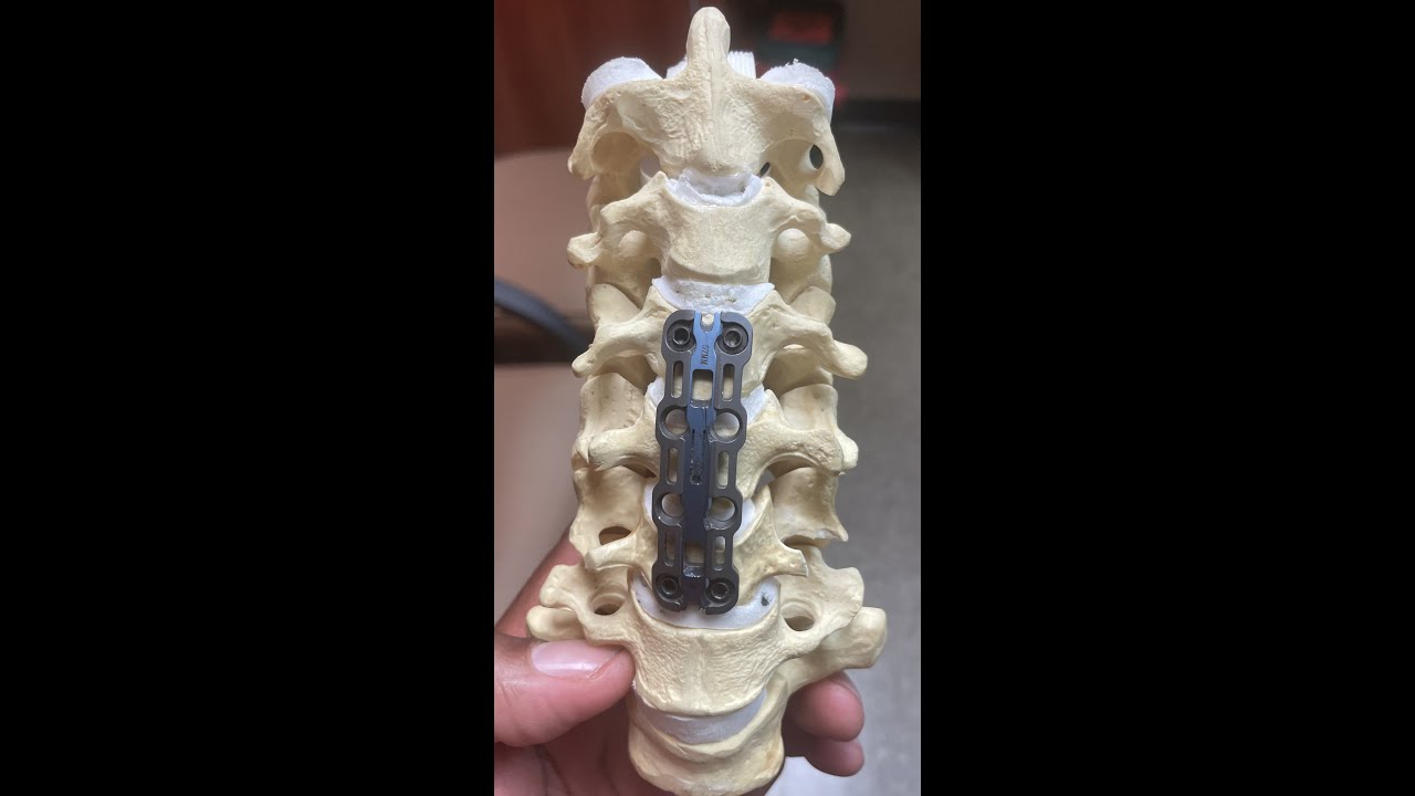 My ACDF STORY PT 1 1080p30 4 - YouTube