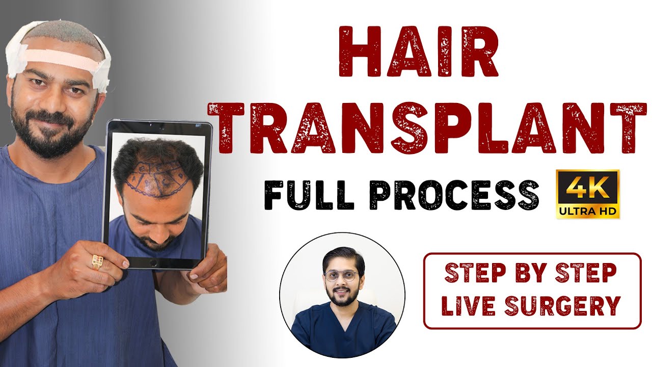 (Live) Hair Transplant Process | Step by Step | Dr. Ankit Khasgiwala ...