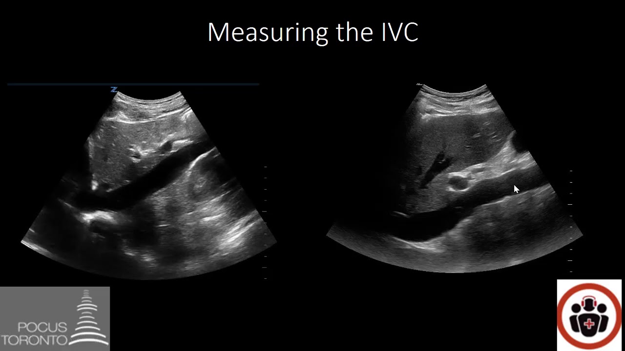 POCUS Cases 4: IVC POCUS for volume status - YouTube