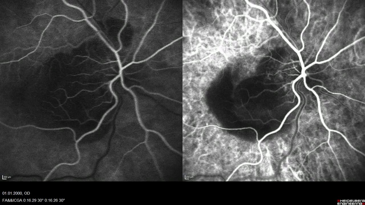 SPECTRALIS FA ICGA Simultan - YouTube