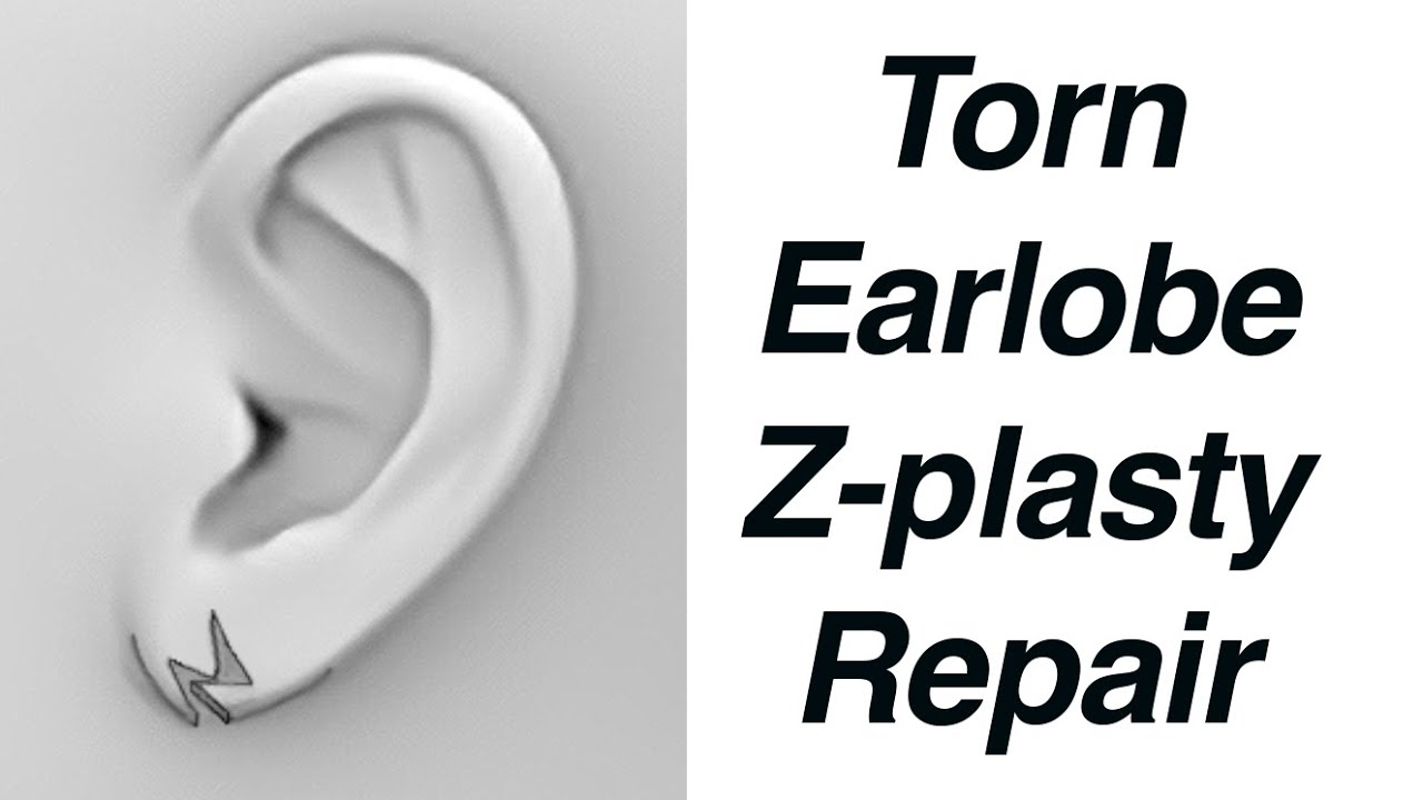 Torn Earlobe Z plasty Repair - YouTube