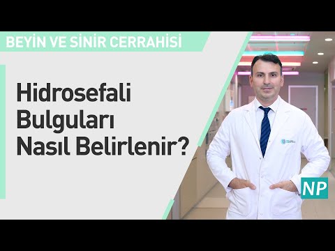 Hidrosefali Bulguları Nasıl Belirlenir?
