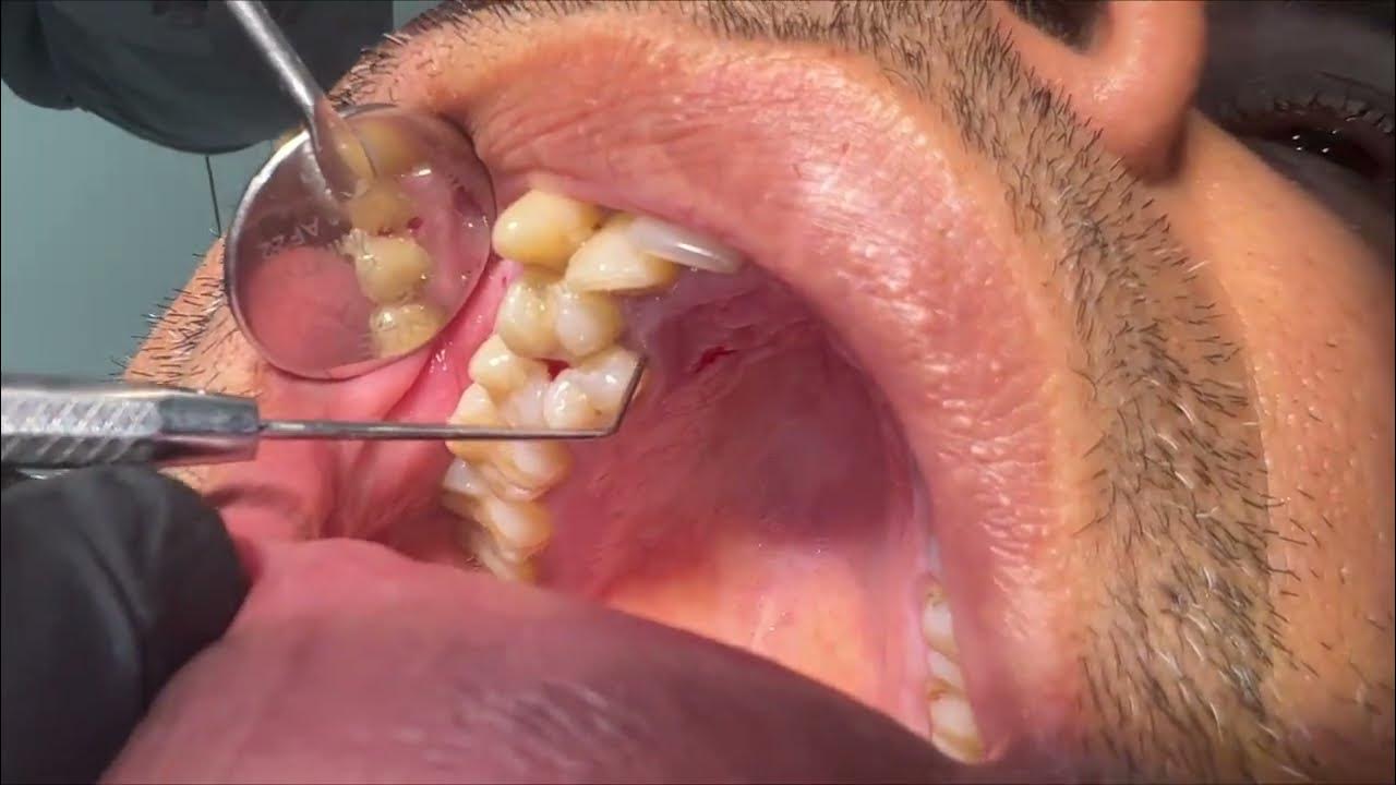 EXTRACTION OF SUPRANUMERARY TEETH |DENTAL EXTRACTION| DENTAL JI - YouTube