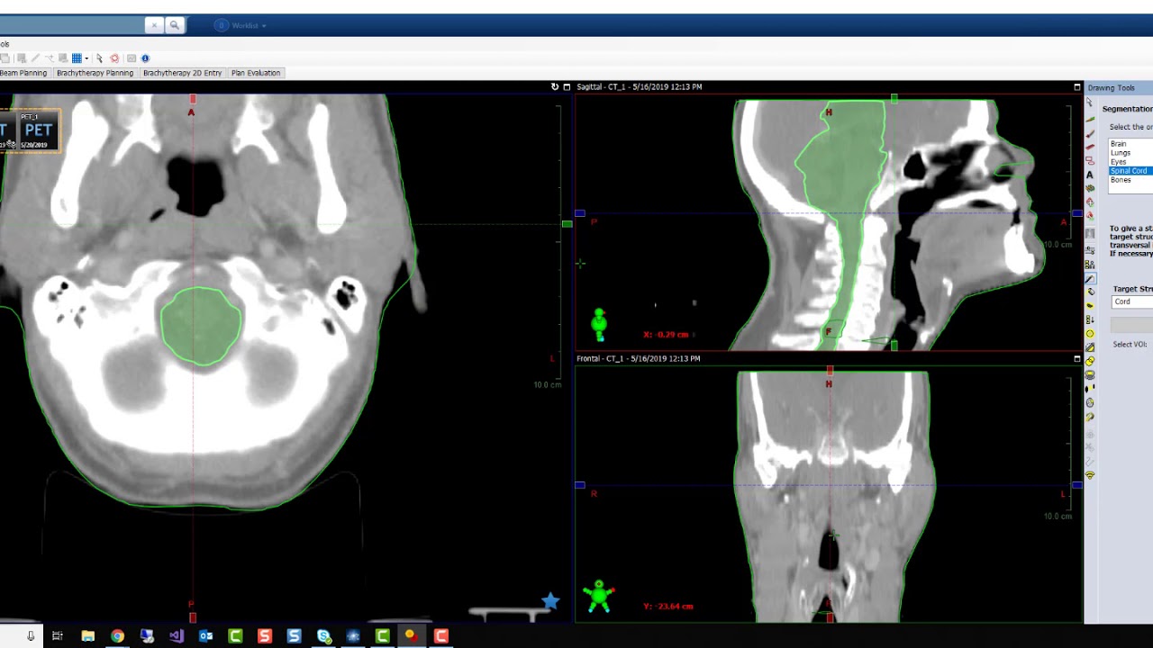 Varian Eclipse Contouring Basics - YouTube