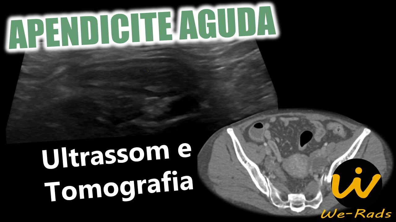 Ultrassonografia De Apendice Normal EPOS™