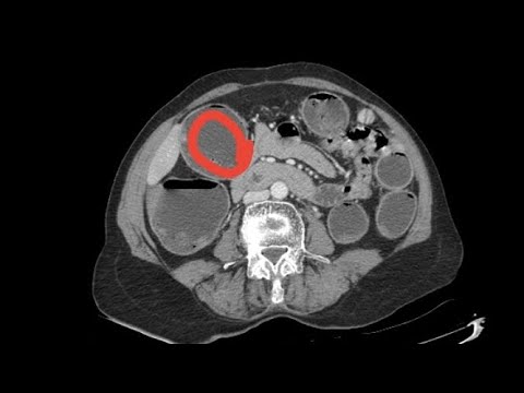 coloscanner V.S scanner standard - YouTube