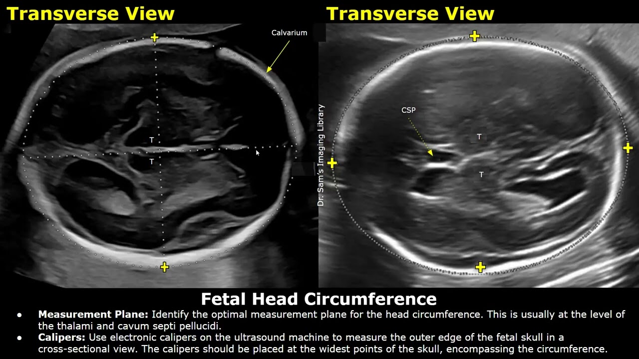 How To Measure Fetal Head Circumference HC On Ultrasound Biometric How To Measure Fetal Head Circumference HC On Ultrasound Biometric