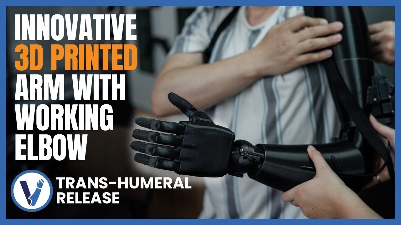 Changing Lives: 3D Printed Above-Elbow Prosthetic Unveiled! - YouTube