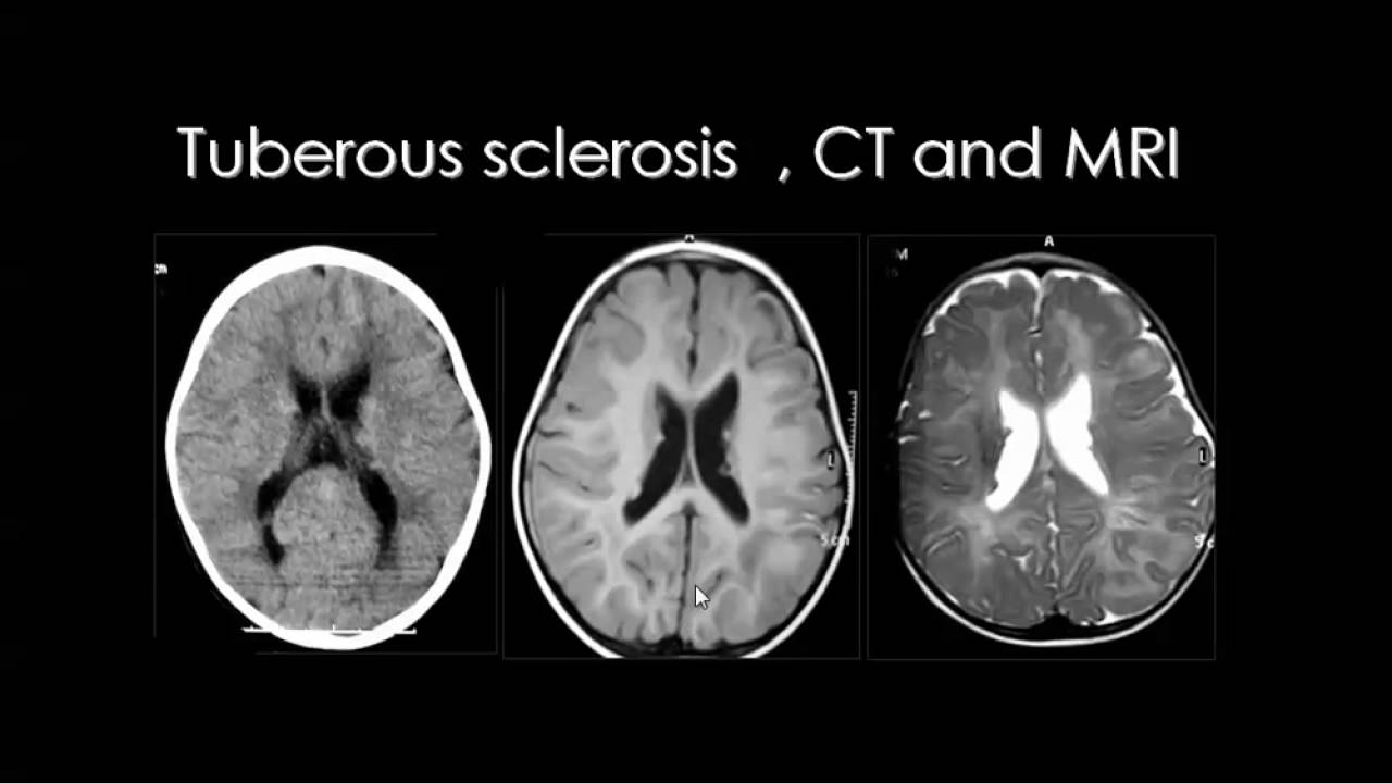 Tramline Intracranial Calcifications Sturge Weber Syndrome