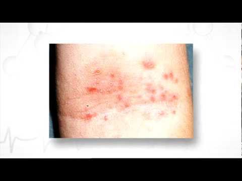 Chronic Skin Conditions - Eczema - YouTube