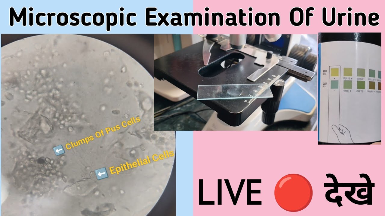 Microscopic Examination Of Urine | Microscopic Examination Of Urine ...
