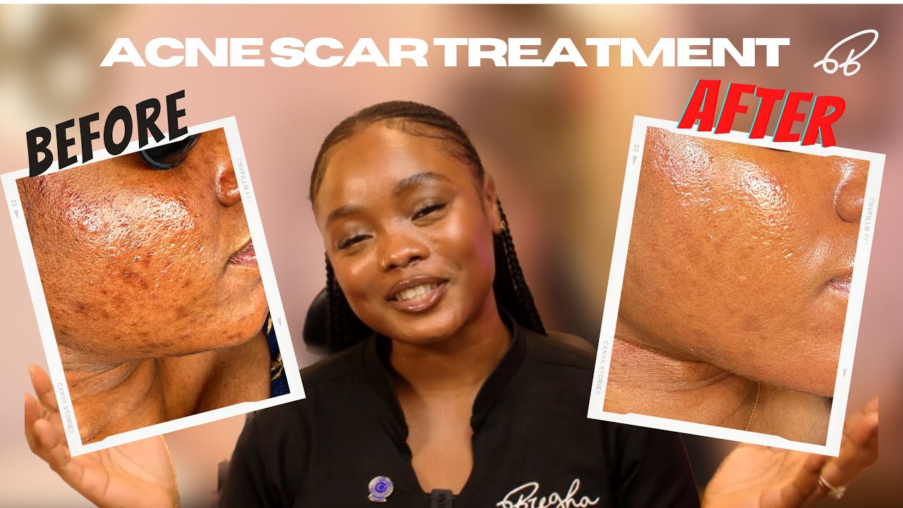 TCA Cross Before and After - YouTube Music