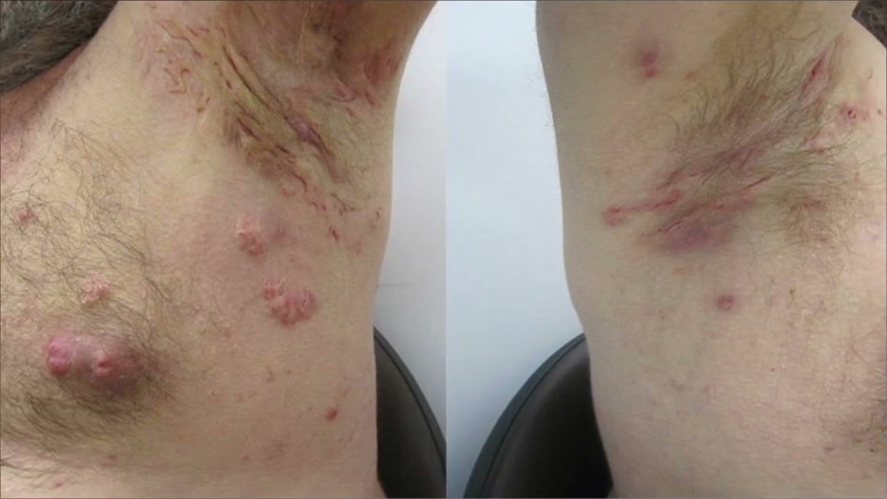 Hidradenitis! Painful Lumps Under the Skin - YouTube