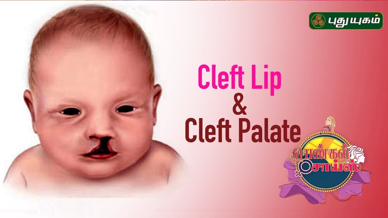 Facts about Cleft Lip and Cleft Palate | மருத்துவ ஆலோசனை | Pengal ...