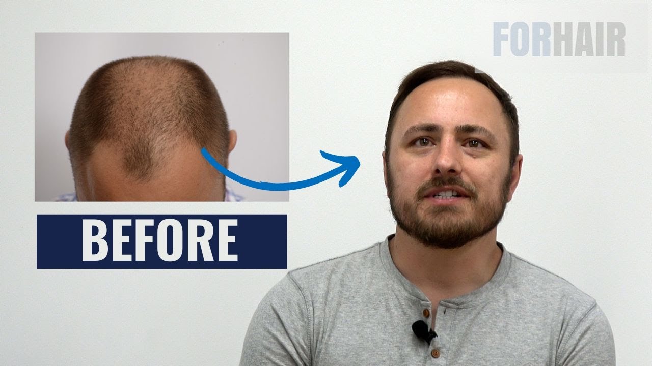 Ultimate Hair Transplant Transformation: Mark Tompkins' Journey ...