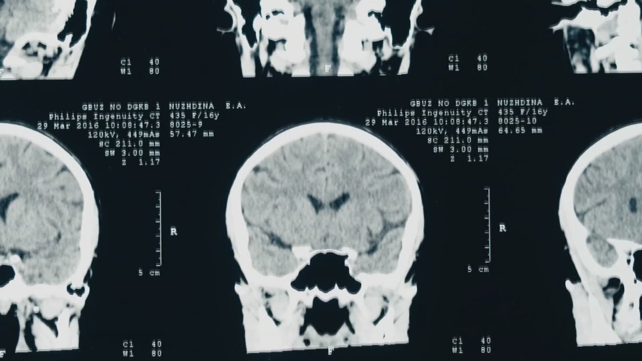 Life-changing concussion care at UPMC draws patients from around the ...