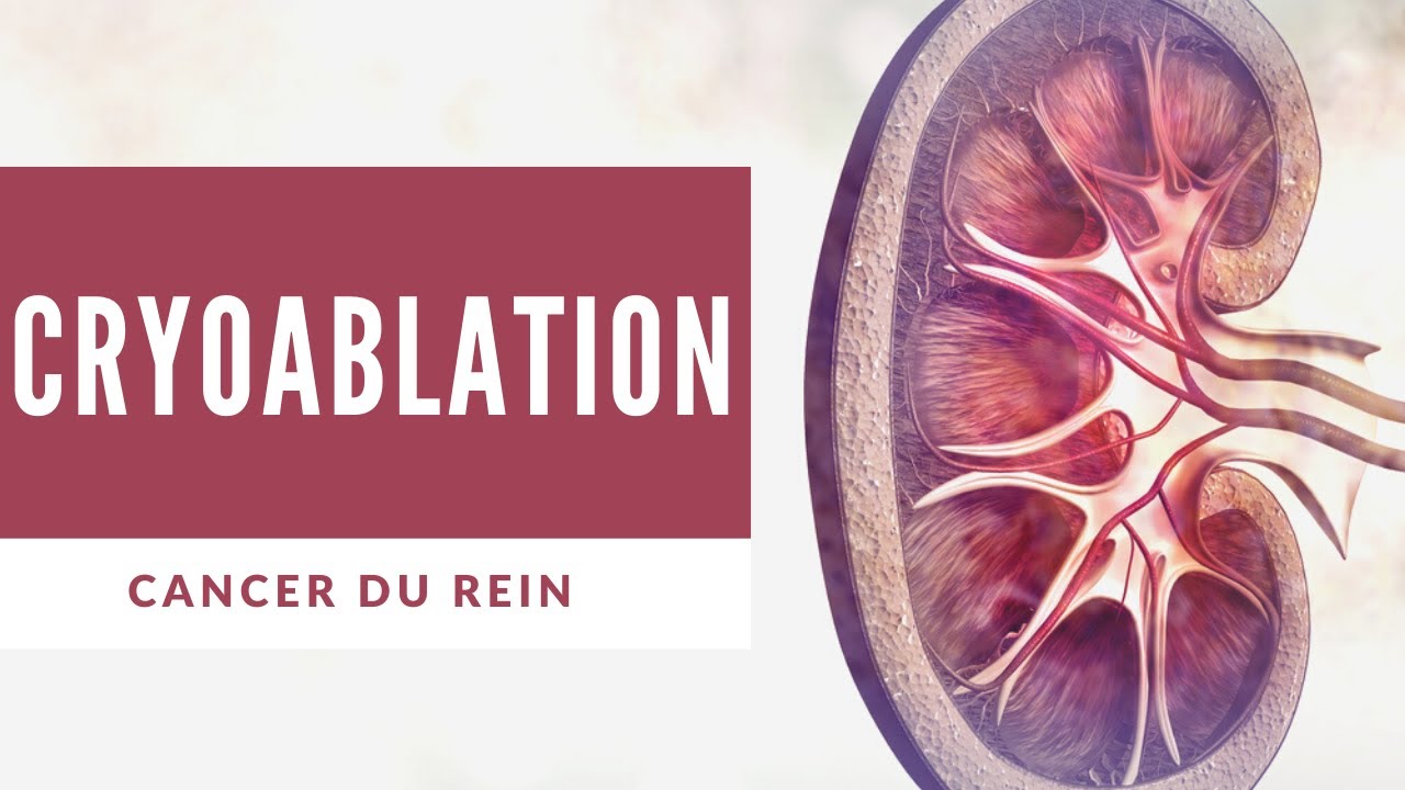 Cryoablation Cancer rénal sans Chirurgie par Radiologie ...