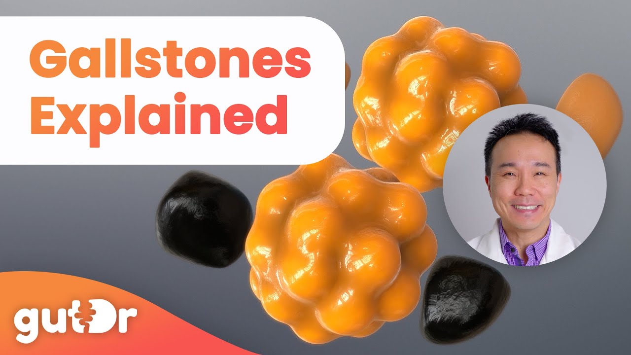 Gallstones - What Are the Causes and Symptoms? | The GutDr Explains (3D ...