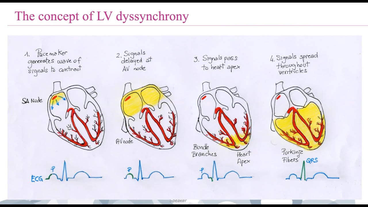 The role of nuclear cardiology in the evaluation of dyssynchrony - YouTube
