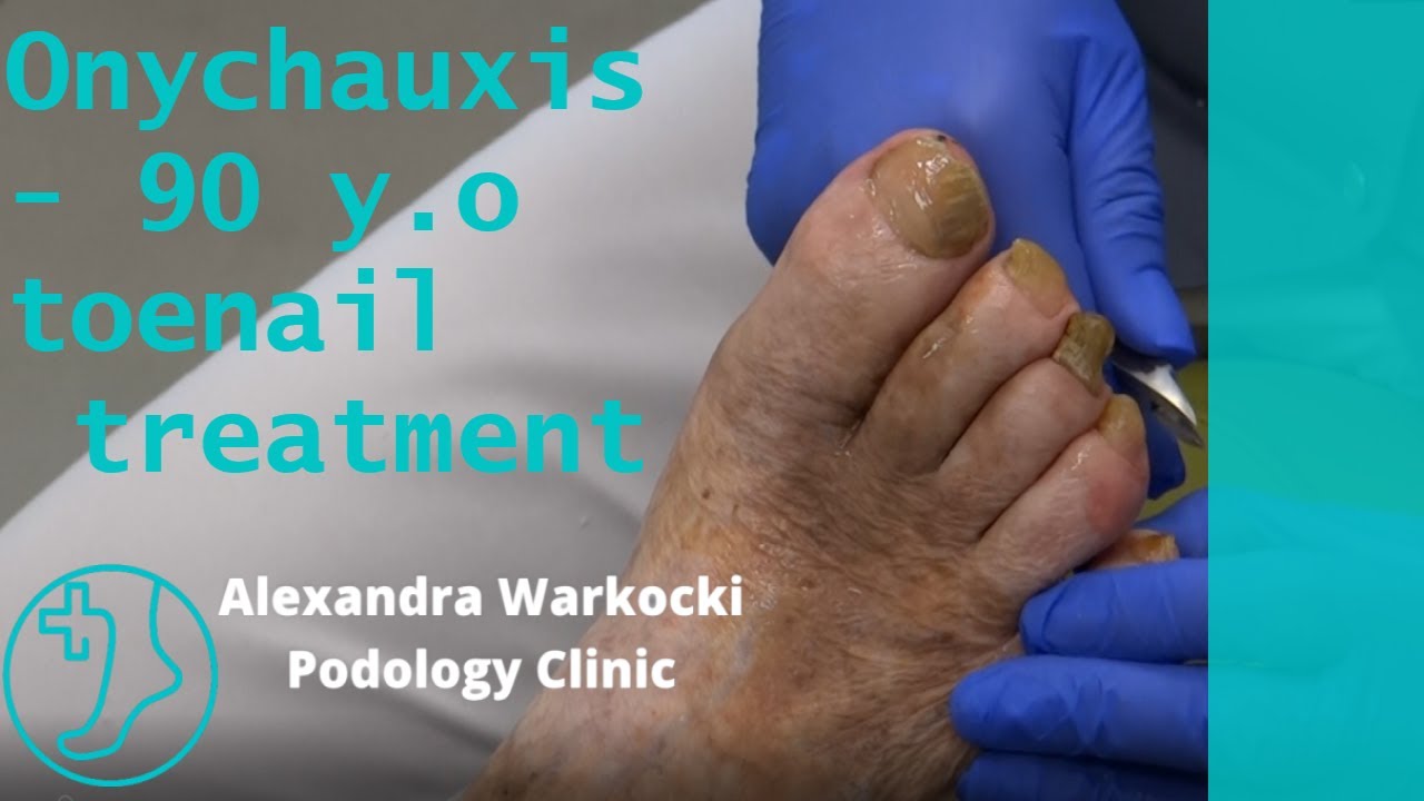 Onychauxis - treatment of 90 year old's toenails. #podology #asmr - YouTube