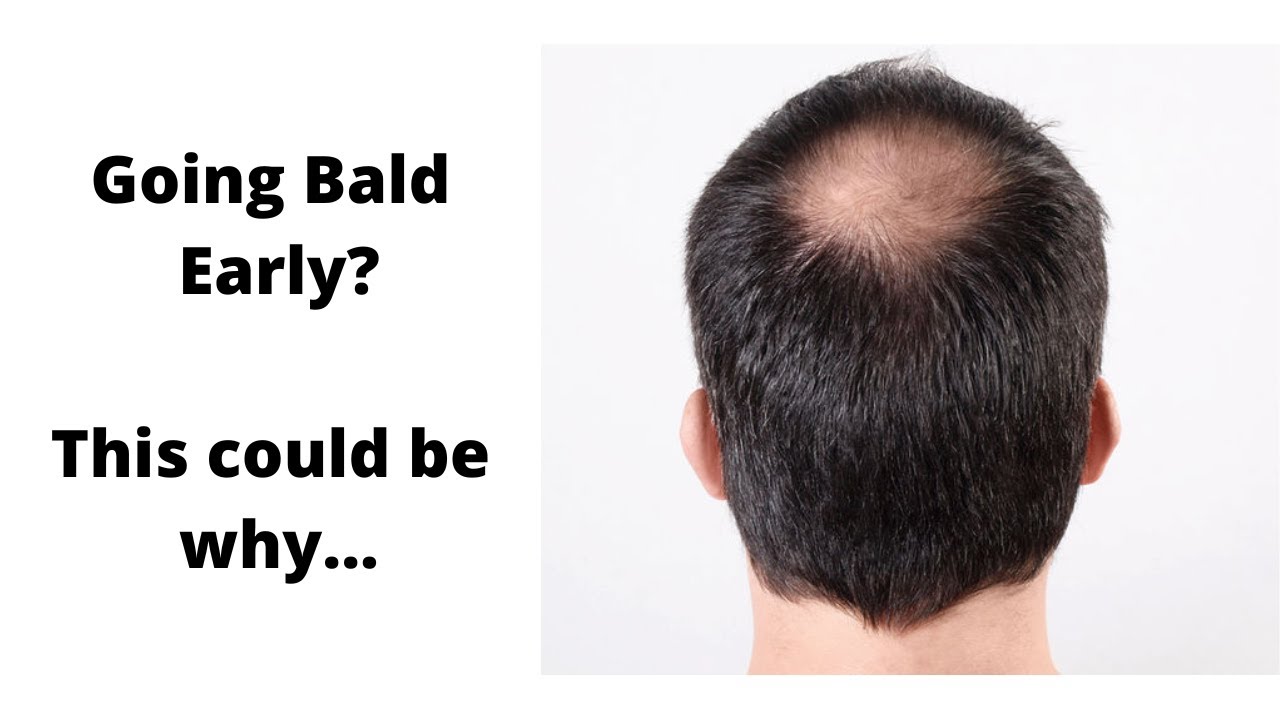 Going Bald Early? This Could Be Why.. | Dr. Health Hair & Skin Clinic # ...