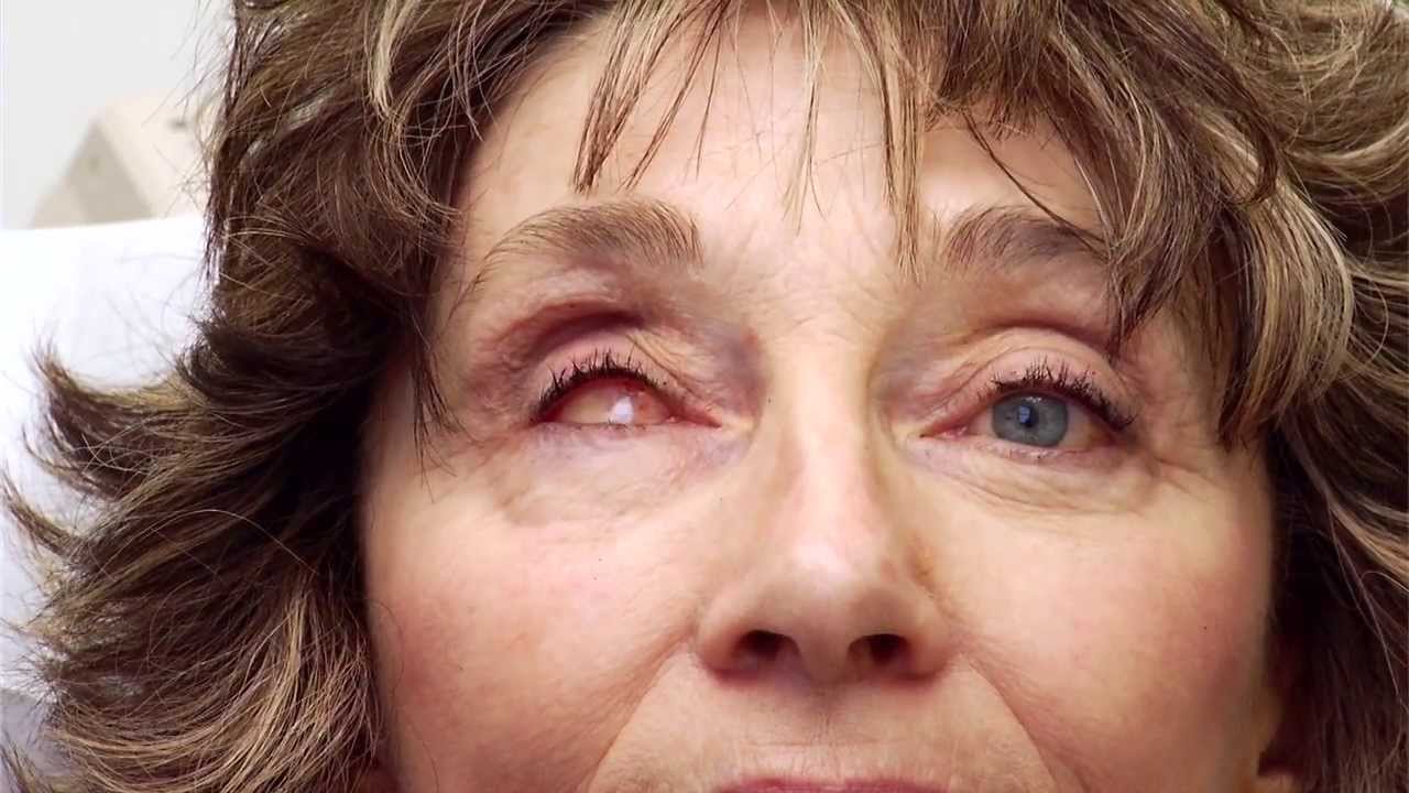Erickson's Eyes: Post-surgical Conformer - YouTube