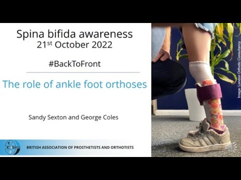 Spina bifida awareness - the role of ankle foot orthoses - YouTube
