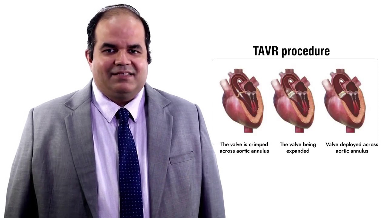 Video about TAVI / TAVR during 3rd Myval certification program at Vapi ...