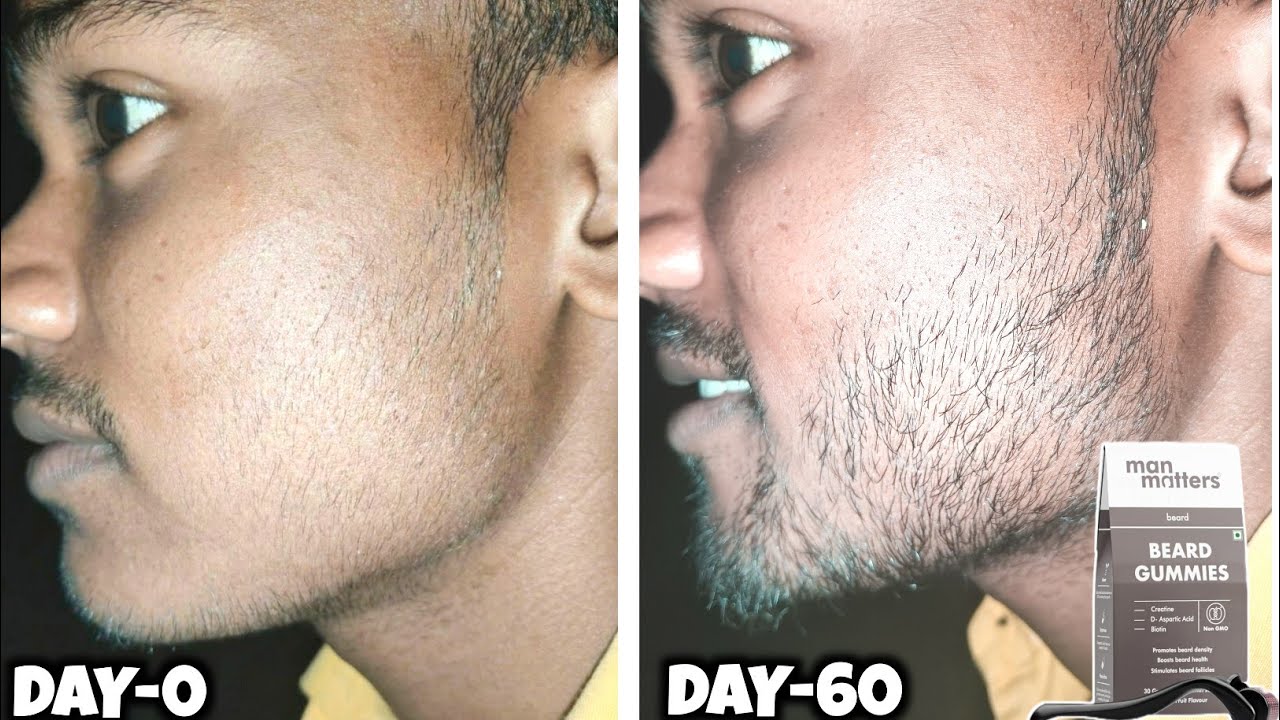 Man matters beard gummies review after use 2 months | man matters beard ...