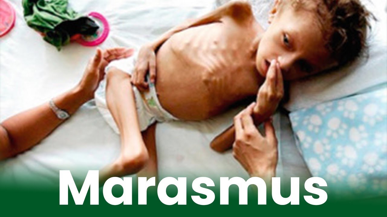 मरास्मस रोग किसकी कमी के कारण होता है? Marasmus Disease: Symptoms ...