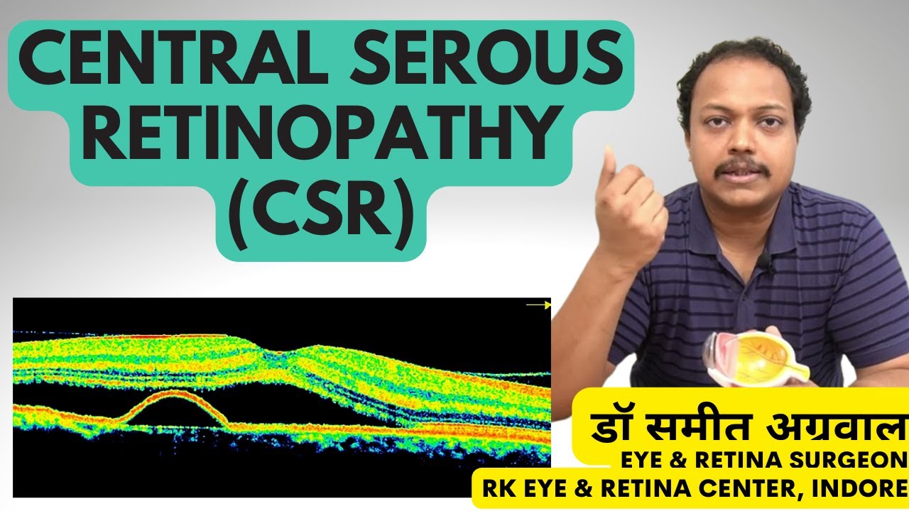 CSR : Central Serous Retinopathy. STRESS की वजह से आँख के पर्दे में ...
