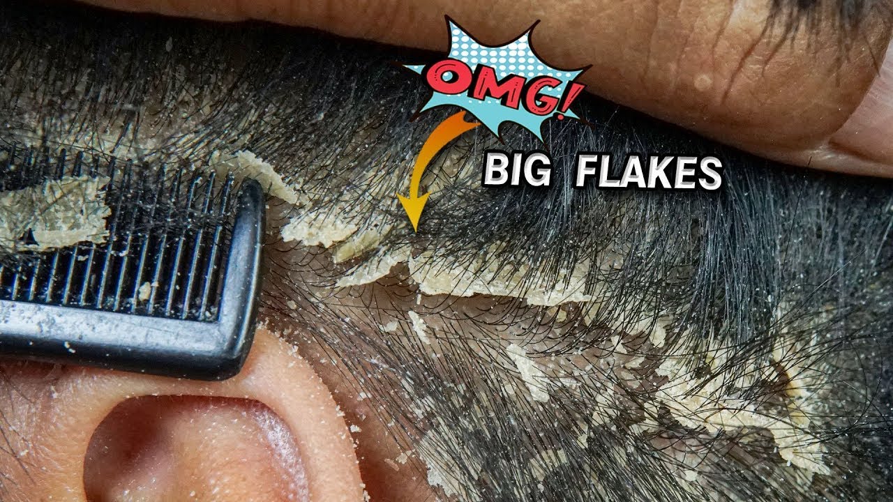 Big Flakes Of Dandruff Scratching Dandruff Removal - YouTube