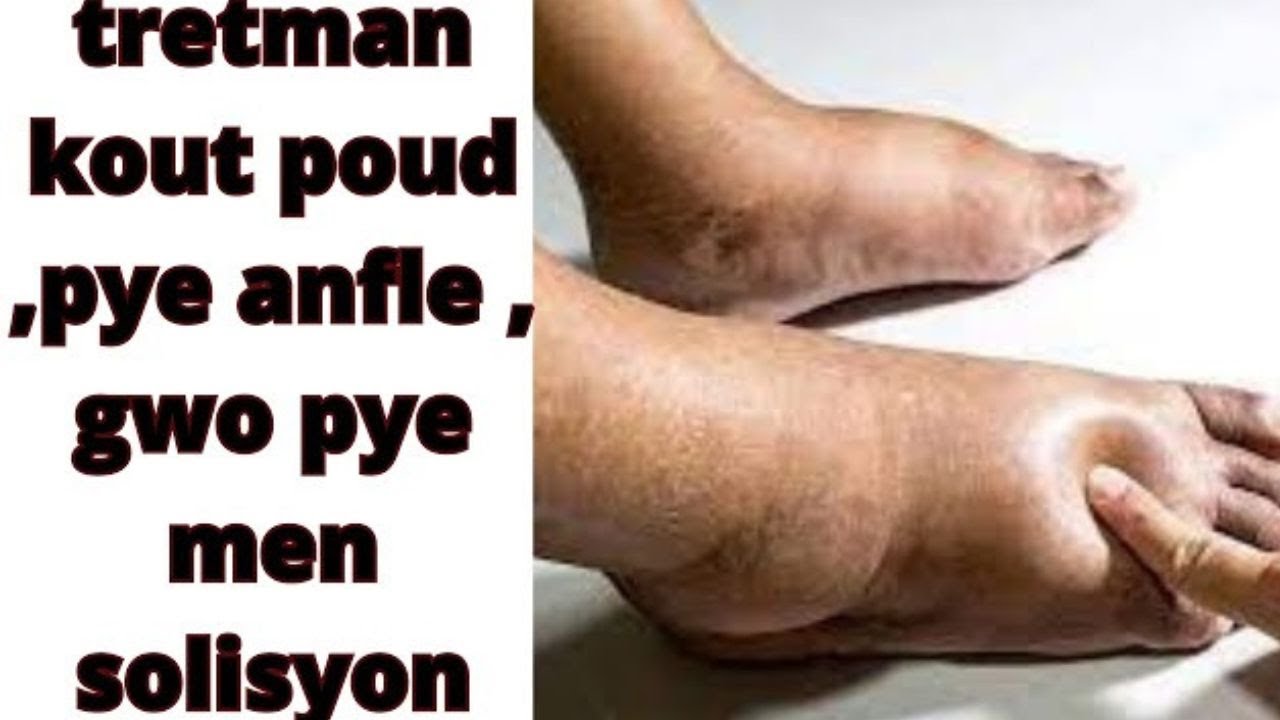 REGLEMAN MISTIK KONT MALADI VANT ANFLE,PYE ANFLE,KÒ ANFLE NAN NATIREL ...