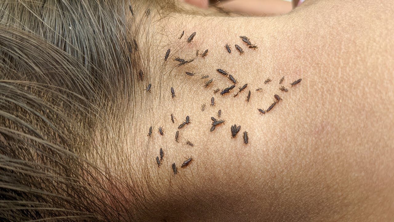 Picking out all hundred lice from long hair - Head lice removal - YouTube